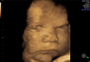 4D Sonography Image Gallery - Advanced Ultrasound Services