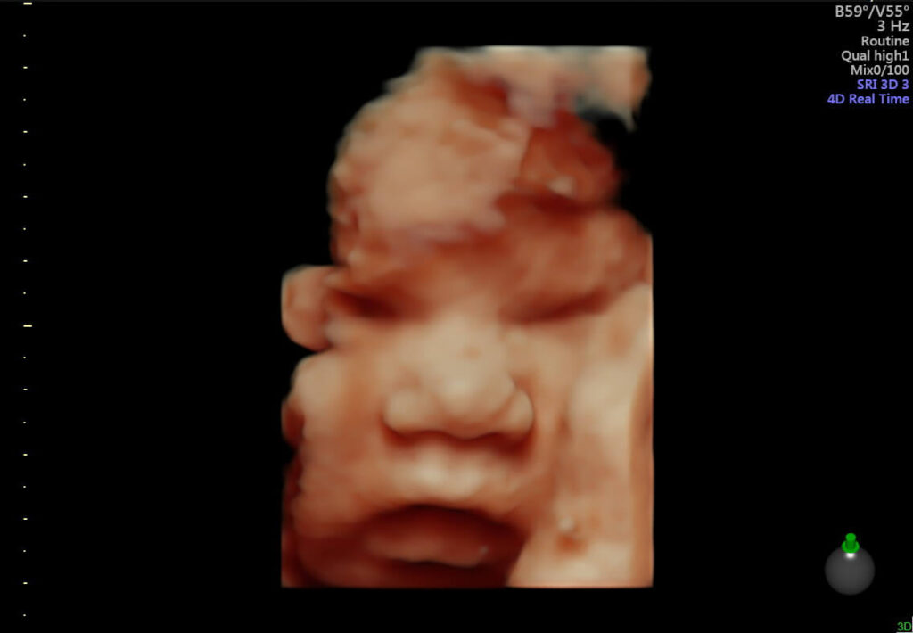 4D Sonography Image Gallery - Advanced Ultrasound Services